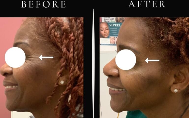 Crows feet botox